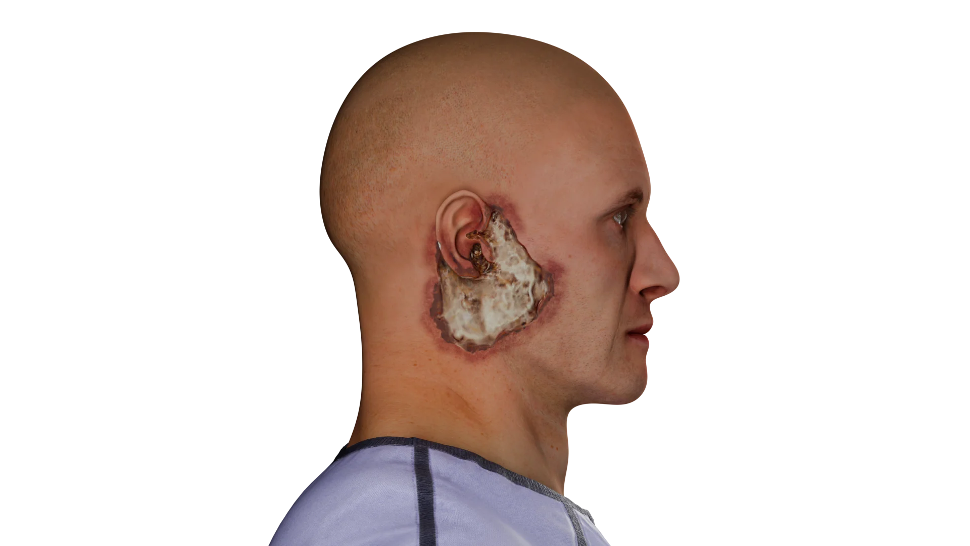 Otitis media externa: Clasificación, causas, síntomas, diagnóstico y tratamiento